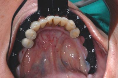 Universal Implant Guides - Upper + Lower Jaw (500540)